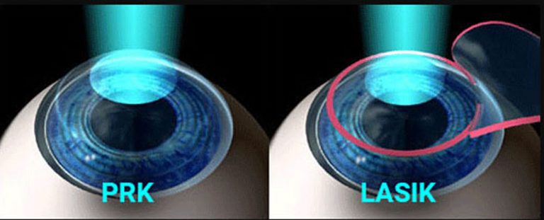 laser μυωπιας θεσσαλονικη | Οφθαλμίατρος Θεσσαλονίκη Βασάκος Δημήτριος